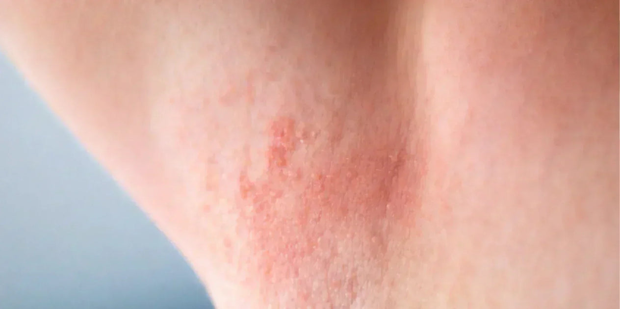 Histamine Reaction After Waxing: Causes, Symptoms & Care – WAXBARE